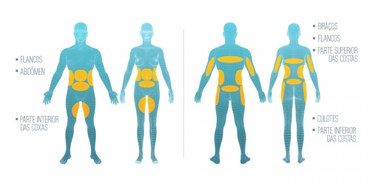Criolipólise funciona? Saiba tudo sobre o tratamento que elimina ...